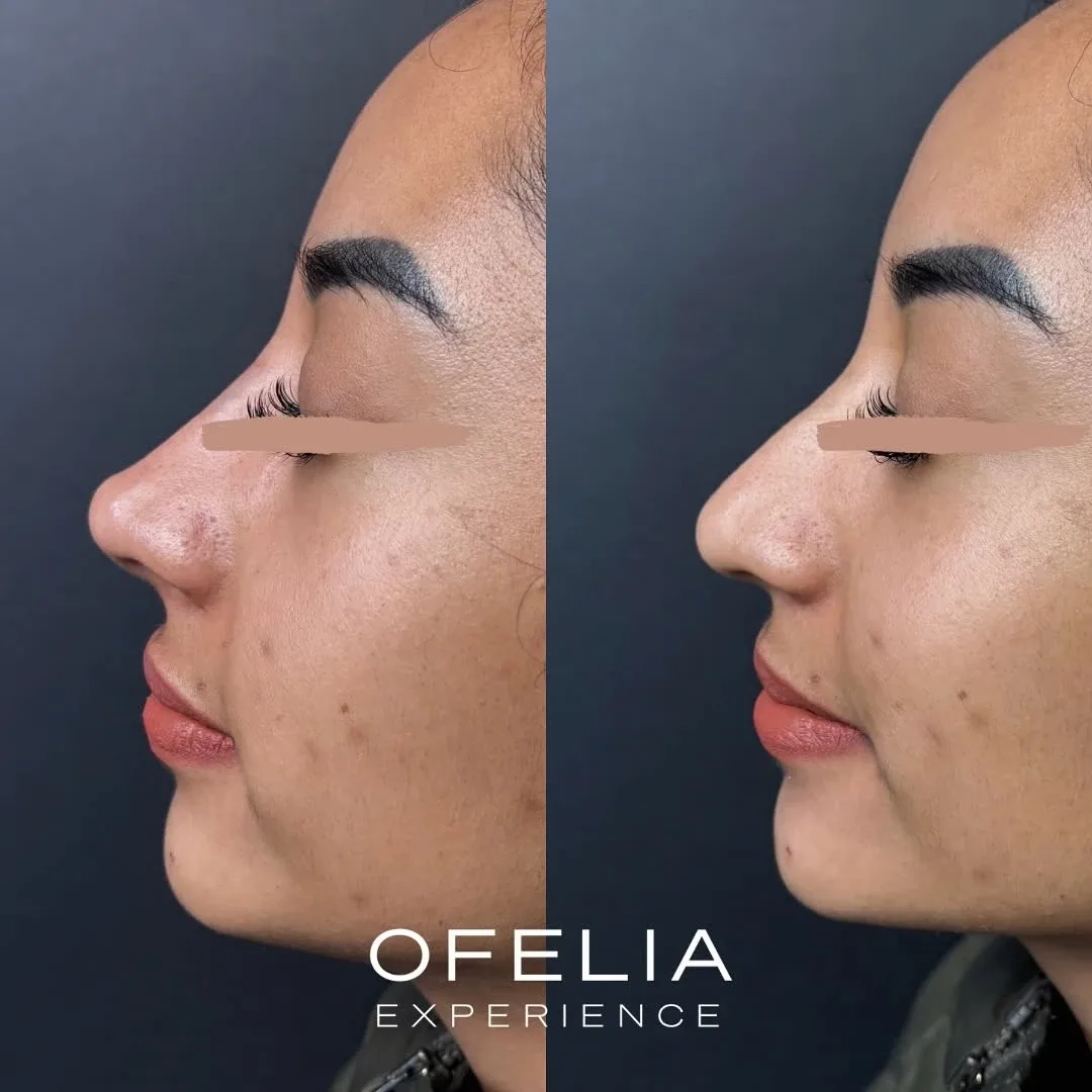 Aprende Rinomodelación con Ácido Hialurónico para Profesionales